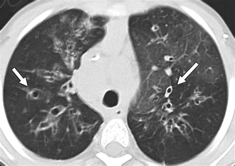 Pancreatic Calcifications And Calcified Pancreatic Masses Pattern