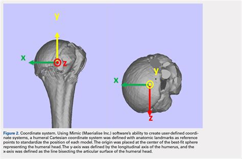 Proximal Humerus Fracture 3 D Modeling MDedge