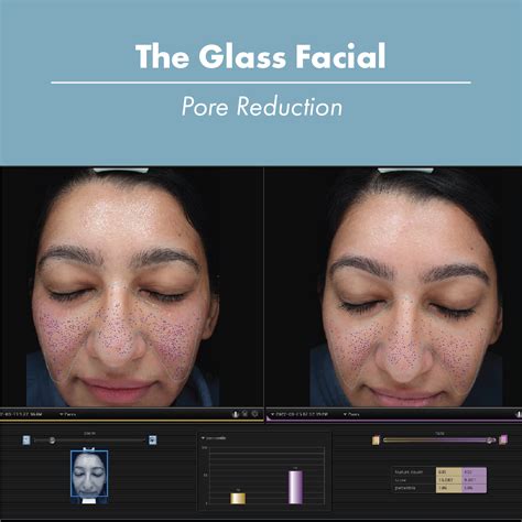 The Glass Facial Vampire Facial Microneedling Treatments