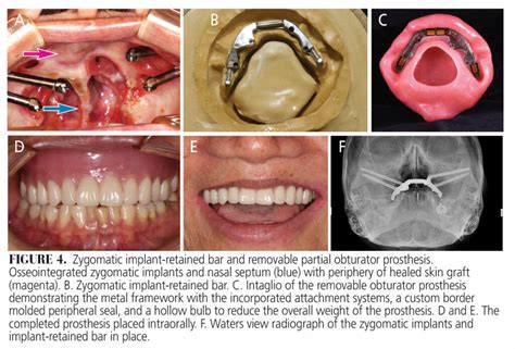 Long Term Dental Care For Post Maxillectomy Patients Decisions In Dentistry