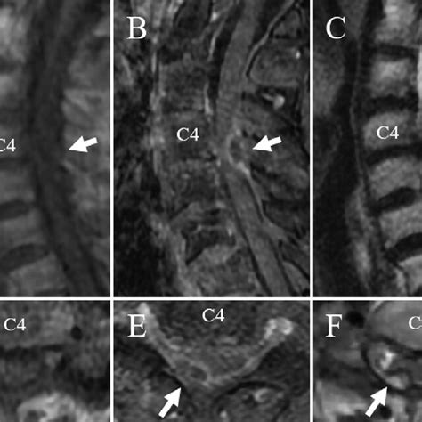 Preoperative Sagittal T1 Weighted Image A Contrast Enhanced