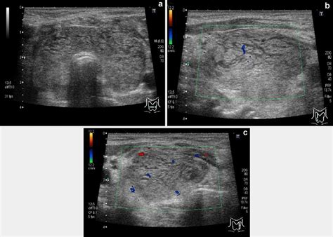 Fig 22 Simple Diffuse Goiter A Transverse Ultrasound