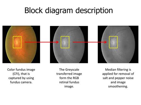 Ppt ‘ Glaucoma Detection In Retinal Images Using Automated Method Powerpoint Presentation