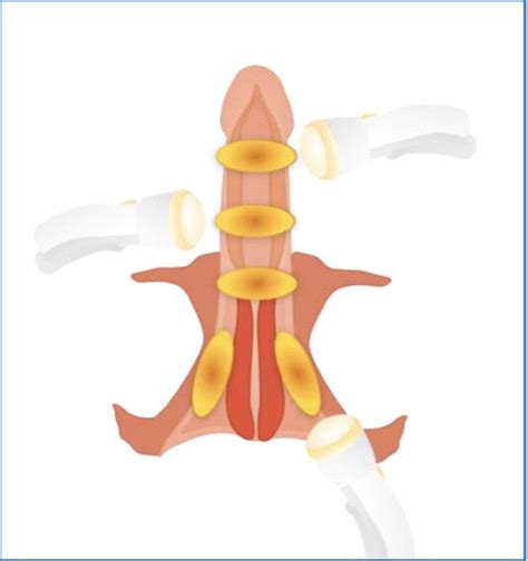 Shock Wave Therapy Mountain View El Camino Urology Group