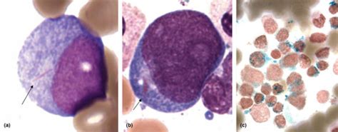 11b Acute Myeloid Leukemias Flashcards Quizlet