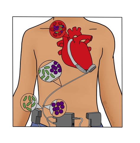 Lvad Infections 101 Criticalcarenow
