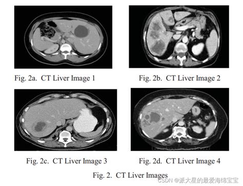 8论文学习liver Tumor Segmentation And Classification A Systematic Review