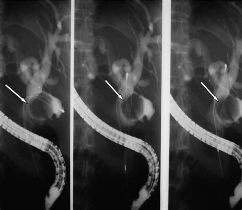 Ercp Showing The Remnant Cystic Duct With A Stone Impacted In It Download Scientific Diagram