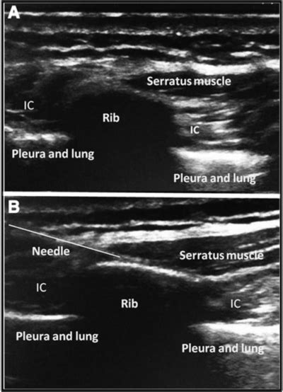 Myofascial Pain Syndrome And Trigger Point Injections Openanesthesia