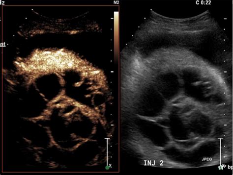 Ovarian Cancer Tumor Ultrasound