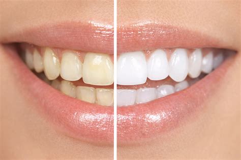 Teeth Whitening Alpan Orthodontics