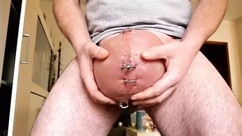 Saline Infusion In Scrotum Second 2 Liter 21 Nude Pics Xhamster