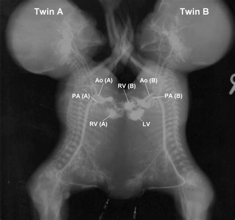 Thoracopagus Conjoined Twins