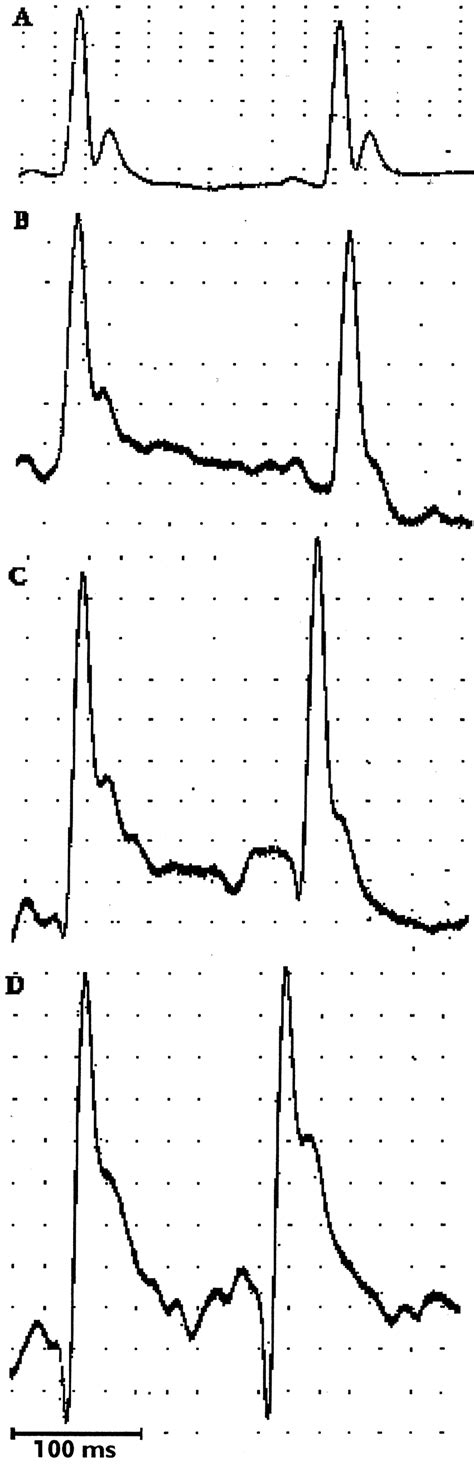 QT Intervals Measured In Vivo In Genetically Engineered Mice Download Scientific Diagram