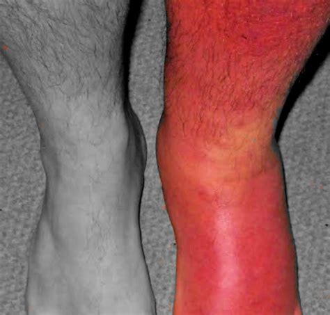 Cellulitis And Lymphoedema
