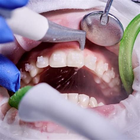 Dental Cleaning West Ryde Keep Your Smile Fresh