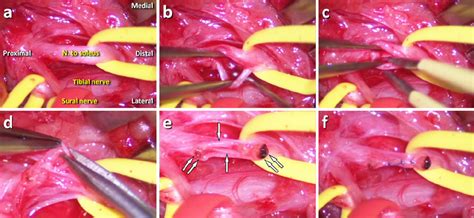 Microsurgical Neurotomy On The Left Tibial Collateral Branches A Download Scientific Diagram