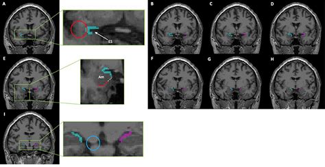 Frontiers The Role Of The Piriform Cortex In Temporal Lobe Epilepsy A Current Literature Review