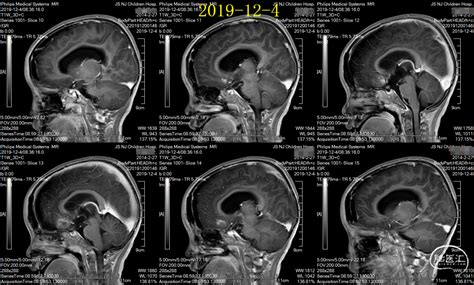 儿童颅咽管瘤的手术治疗 脑医汇