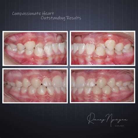 Class Iii Underbite Treated Without Extraction Lawrencevil… Georgia Orthodontic Care Flickr