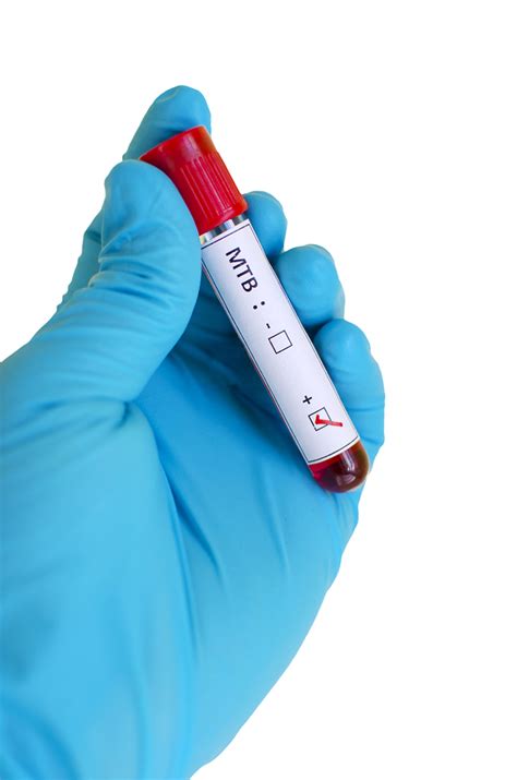 TST Misses TB In Pregnant HIV Women United Lab Service