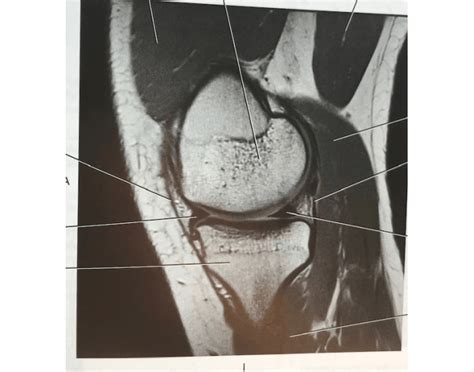 Sagittal T1 Mri Knee Quiz