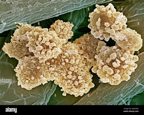 Cervical Cancer Cells Coloured Scanning Electron Micrograph Sem Of Cervical Cancer Cells The