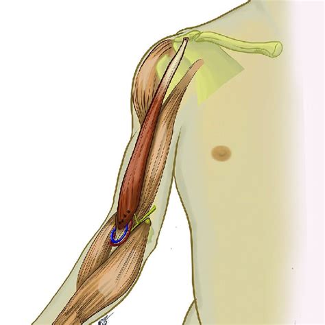 Intraoperative View Of The Antecubital Fossa Dissection Download Scientific Diagram