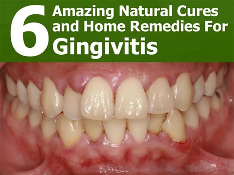 Gingivitis Treatment Medicine At Albert Jarman Blog