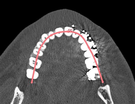 Move Sections Along A Curve Support 3d Slicer Community