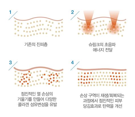 슈링크 리프팅 웰스피부과 파주운정점