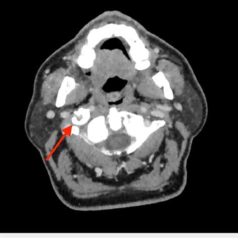 Three Dimensional Ct Scan Of The Head And Neck Showing Enlarged