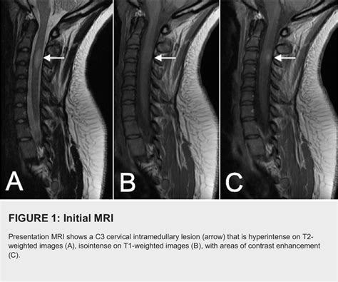 Figure 1 From Tumefactive Multiple Sclerosis Of The Cervical Spinal