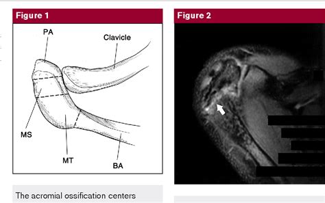 Figure 3 From Symptomatic Os Acromiale Semantic Scholar