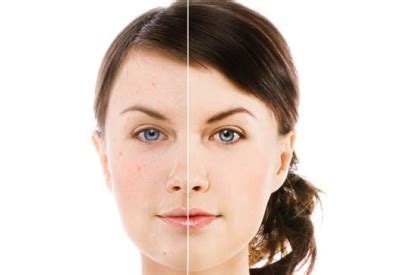 How To Prevent Scars From Pimples