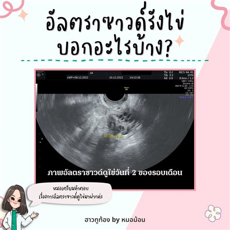 อัลตราซาวด์รังไข่บอกอะไรบ้าง 🥚🥚🧐⁉️ ฮาวทูท้อง By หมอม้อน