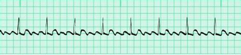 Flutter Fib PVC V Tach VT Asystole Flashcards Quizlet