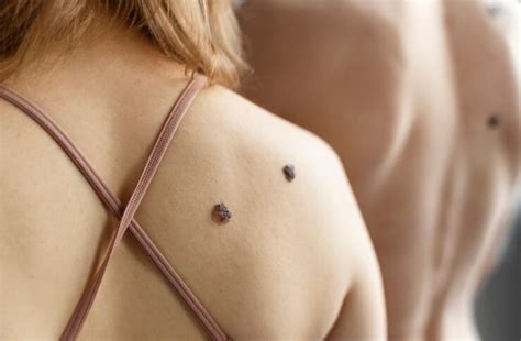 What Is A Skin Tag How To Remove It