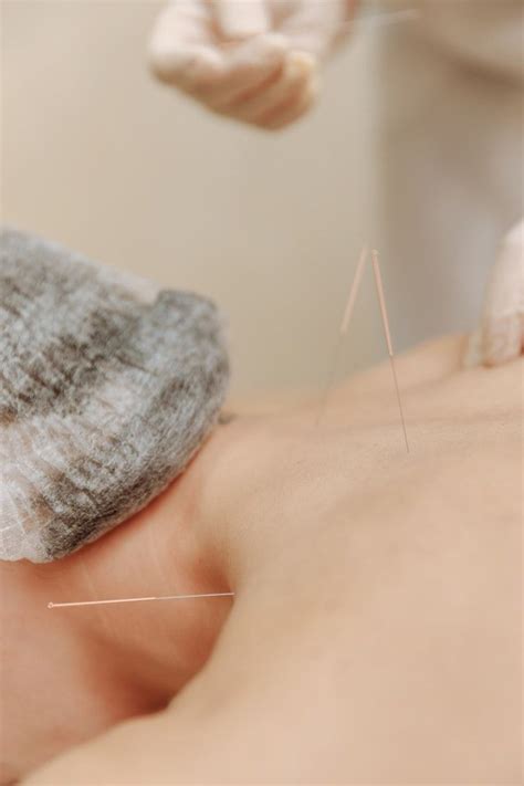 How Does Zhus Scalp Acupuncture Work Acupuncture Acupuncture Clinic Dry Needling