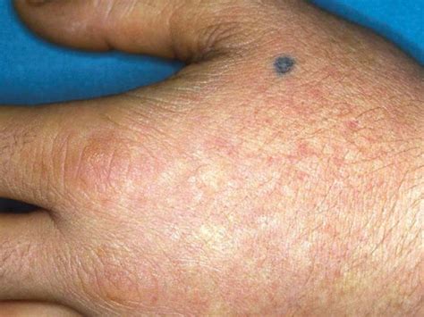 Erythropoietic Protoporphyria Definition Causes Symptoms And More