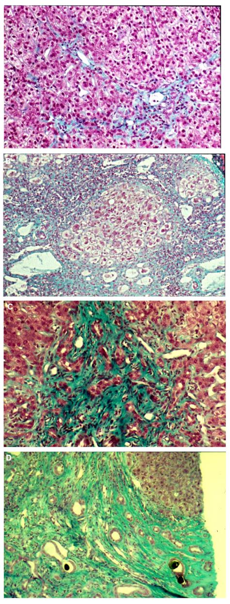 Liver Histology A Liver Histology In A Pfic1 Patient At Age Six