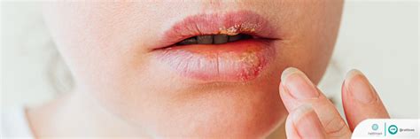 โรคปากนกกระจอก เกิดจากอะไร เป็นแล้วรักษาและป้องกันตัวเองอย่างไร