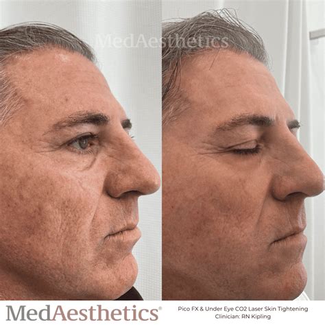 Pico FX Perth Medaesthetics Cosmetic Skin Clinic