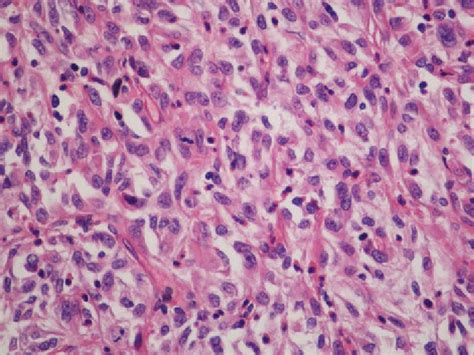 Sarcomatoid Urothelial Carcinoma Spindle Tumor Cells With High Grade Download Scientific