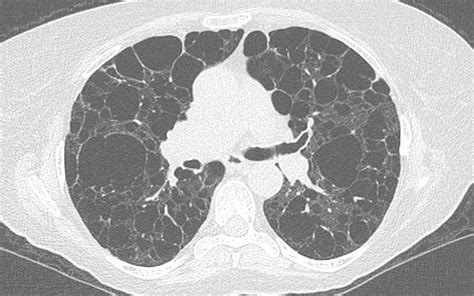 11 Hyperlucent Lung — Radiology Slides
