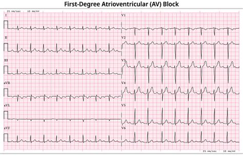 Ecg First Degree Atrioventricular Block 1st Degree Av Block 12 Lead Ecg