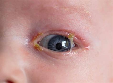 Newborn Conjunctivitis Causes Symptoms Diagnosis Treatment And Prognosis