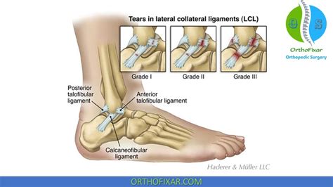 Ankle Sprain Grades