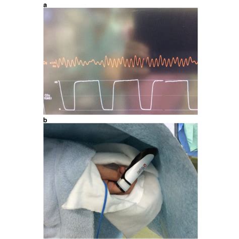 A Pulse Oximetry Plethysmogram With Interference B A Black Plastic