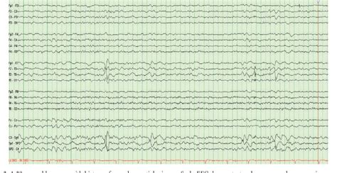 Figure 2 From Electroencephalography In Mesial Temporal Lobe Epilepsy A Review Semantic Scholar